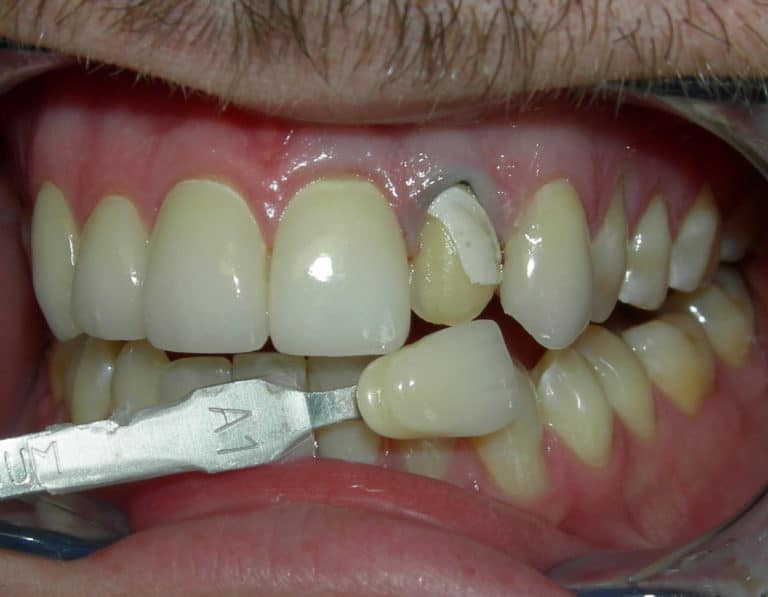 What You Should Do If You Have A Fractured Porcelain Crown?