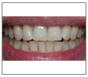 Teeth Bleaching | Cosmetic Dentist in Los Angeles